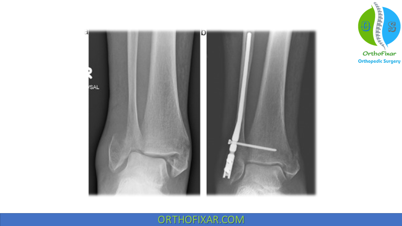 Lateral Malleolus Fracture Treatment