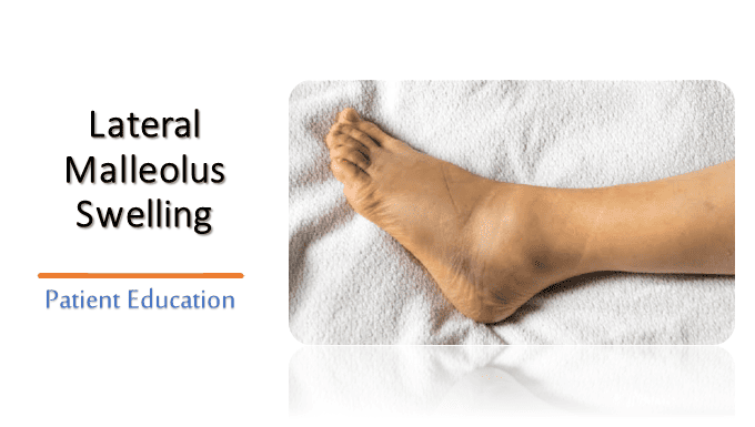 Lateral Malleolus Swelling Causes & Treatment | OrthoFixar