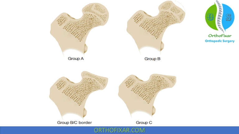 Legg-Calvé-Perthes Disease | OrthoFixar 2025