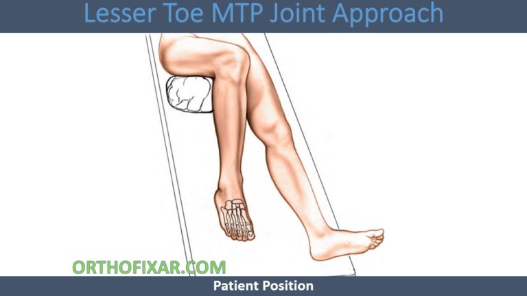 Lesser Toe MTP Joint Approach Easily Explained | OrthoFixar
