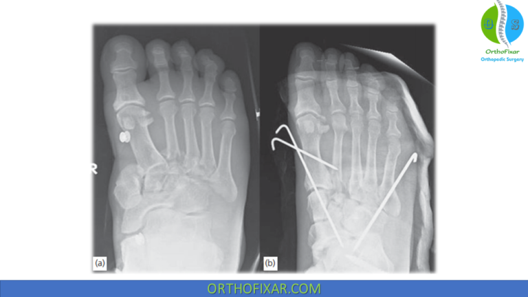 Lisfranc Fracture | OrthoFixar