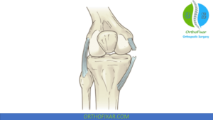 Knee MCL Sprain Overview | OrthoFixar 2025