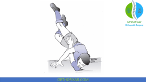 AC Joint Separation - Easy Explained | OrthoFixar 2026