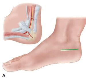 Medial Approach To Calcaneus • Full Tutorial • 2025