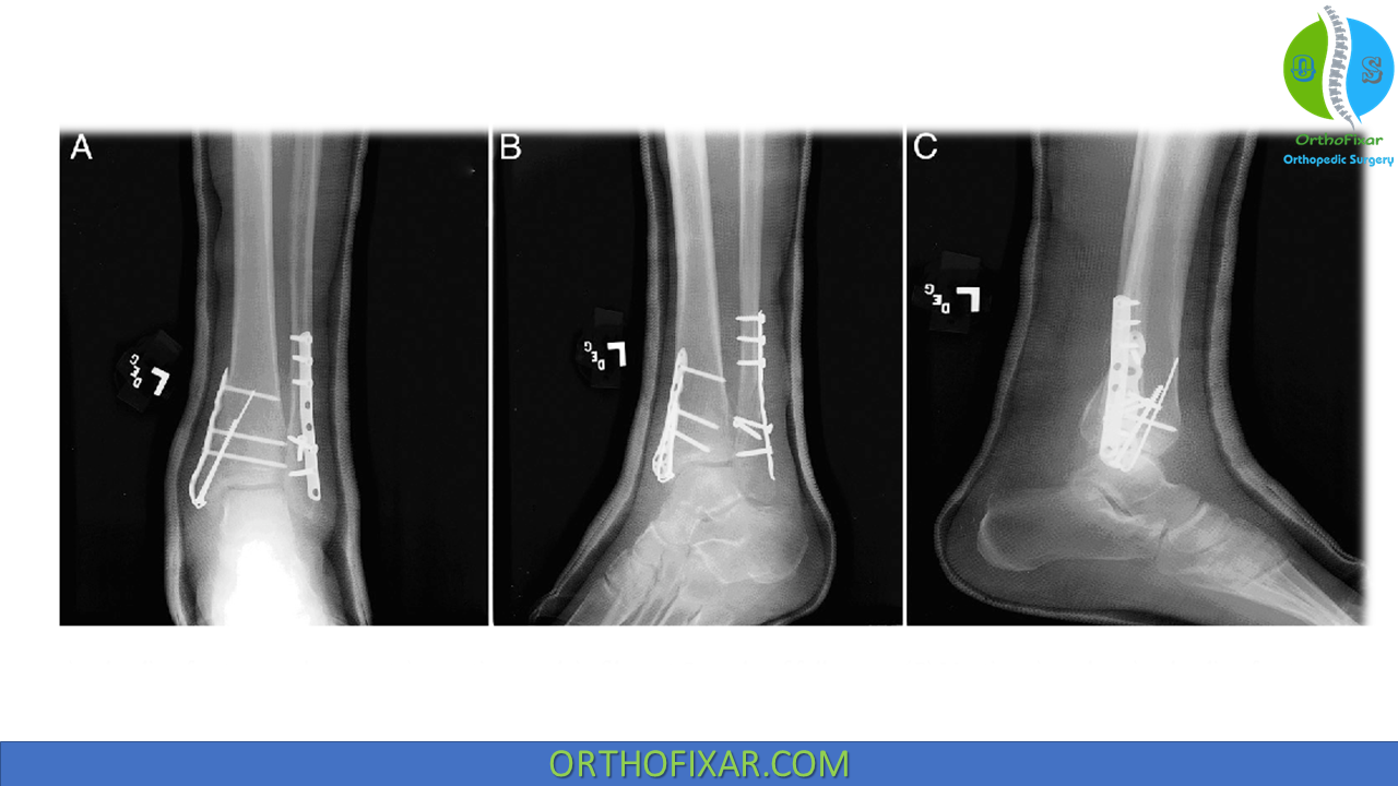 Treatment Of Medial Malleolus Fracture Easily Step-By-Step | OrthoFixar