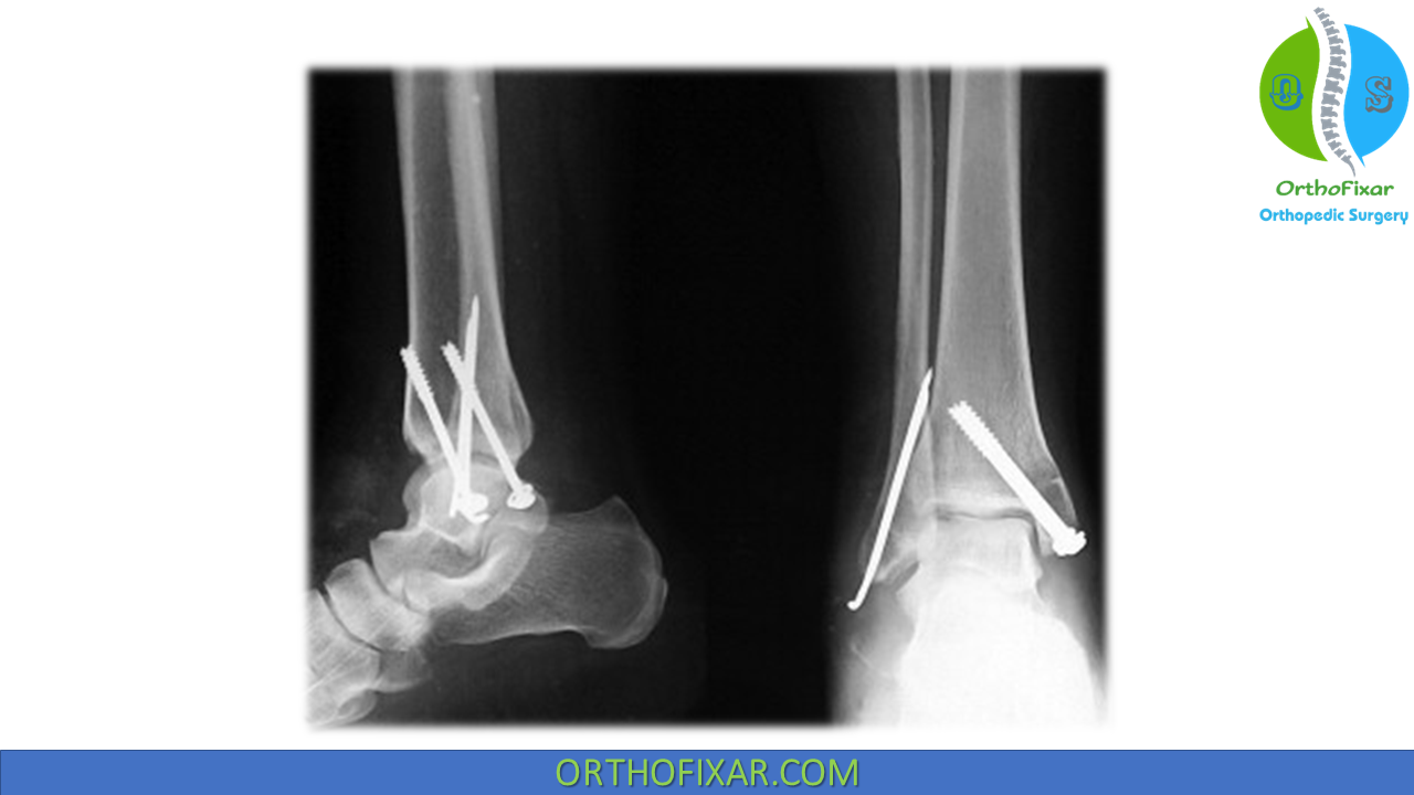 Treatment Of Medial Malleolus Fracture