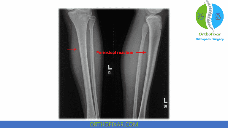 Medial Tibial Stress Syndrome • Easily Explained | 2026