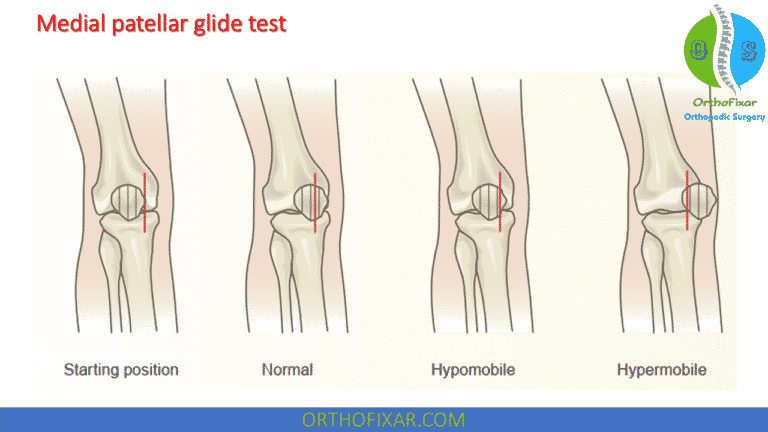 Patellar Glide Test Explained Easily Orthofixar