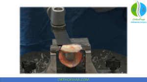 Knee Meniscal Transplantation