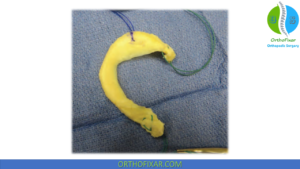 Knee Meniscal Transplantation