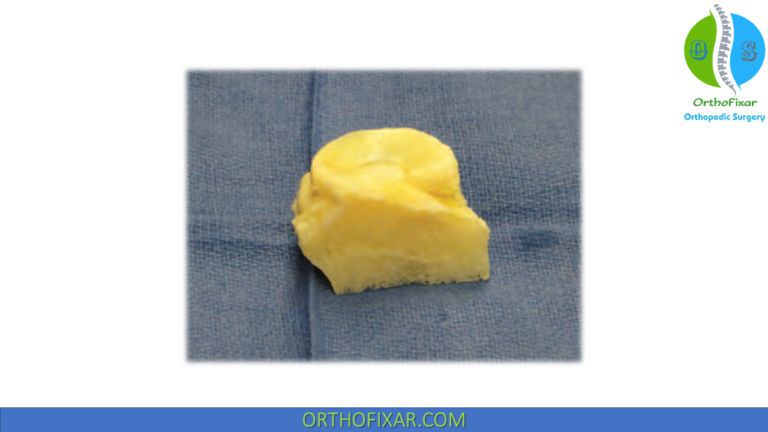 Knee Meniscal Transplantation Easily Step-By-Step | OrthoFixar