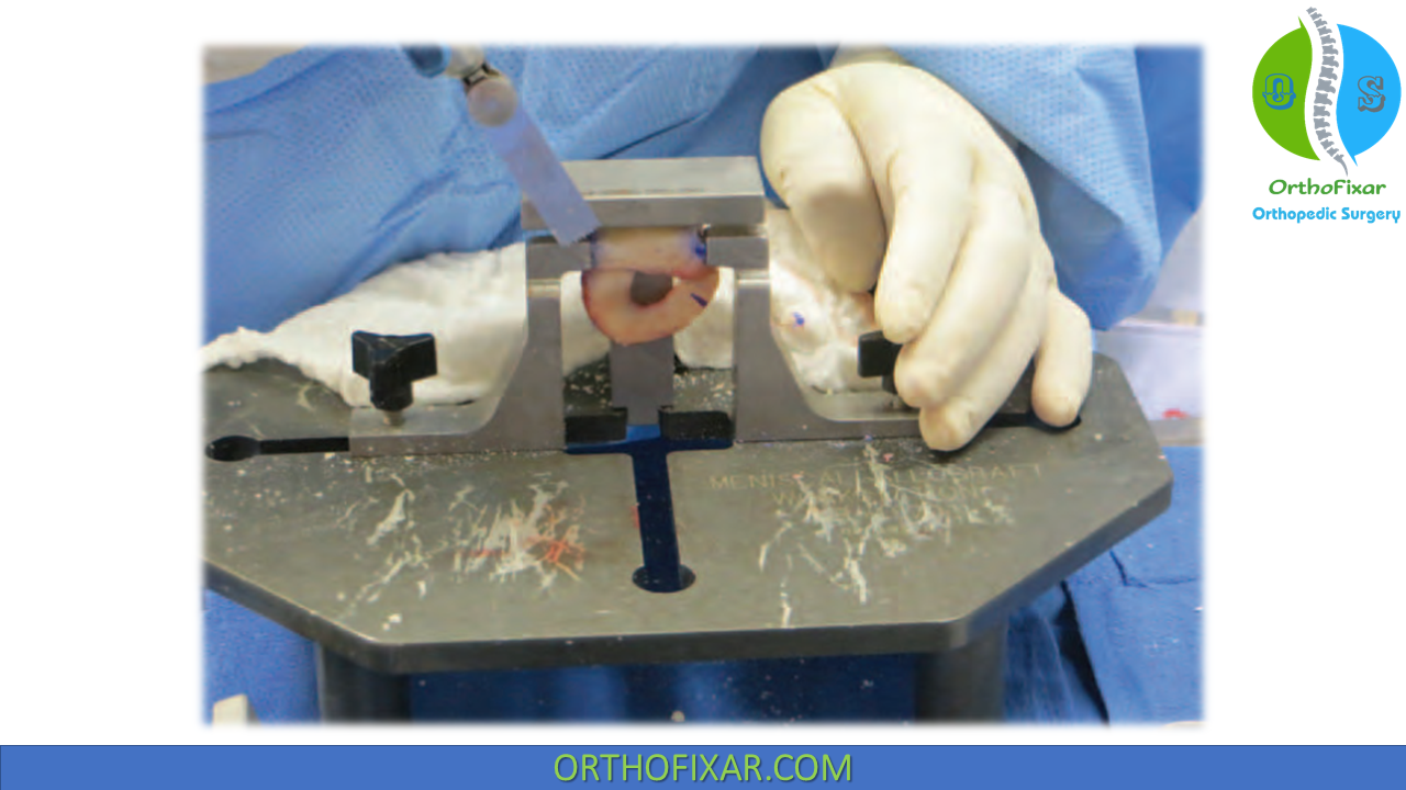 Knee Meniscal Transplantation