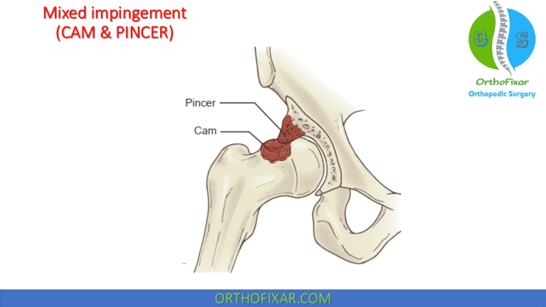 Femoroacetabular Impingement (FAI) | OrthoFixar