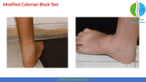 Coleman Block Test Explained Easily | OrthoFixar