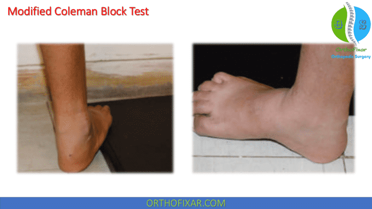 Coleman Block Test