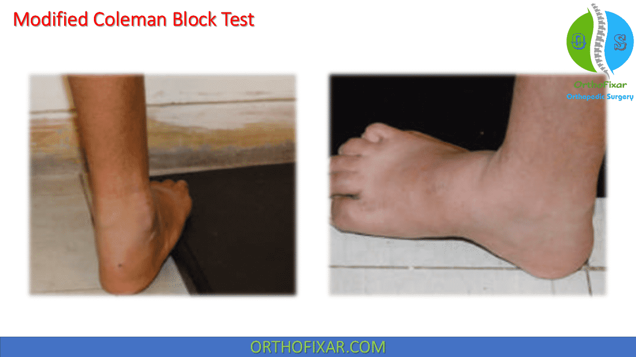 Coleman Block Test Explained Easily | OrthoFixar