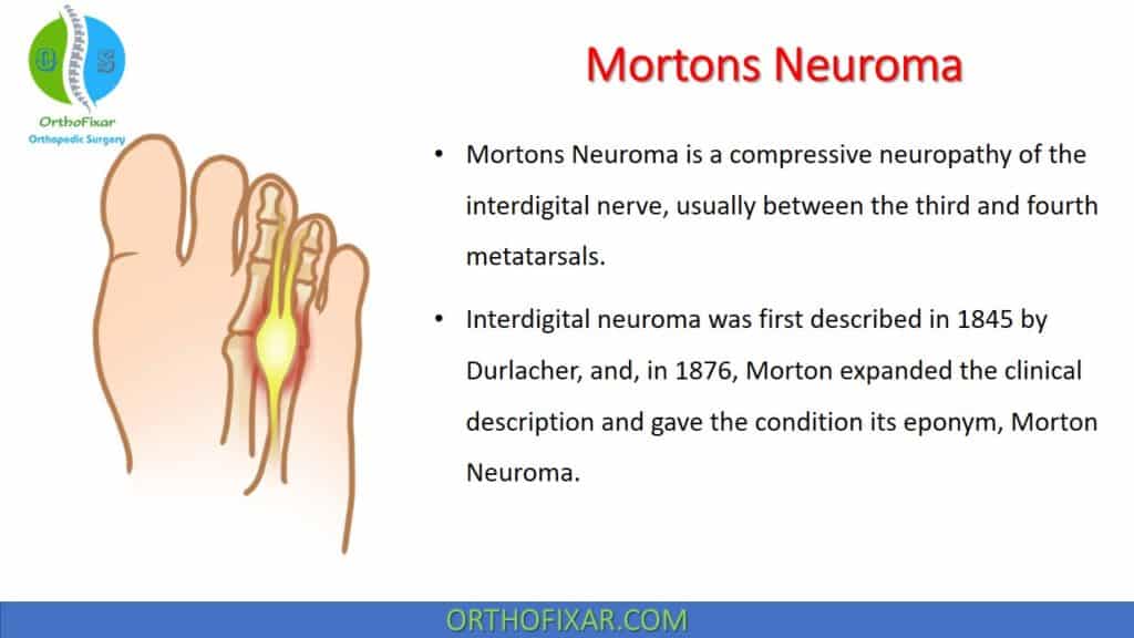 Mortons Neuroma • Easy Explained | OrthoFixar 2025