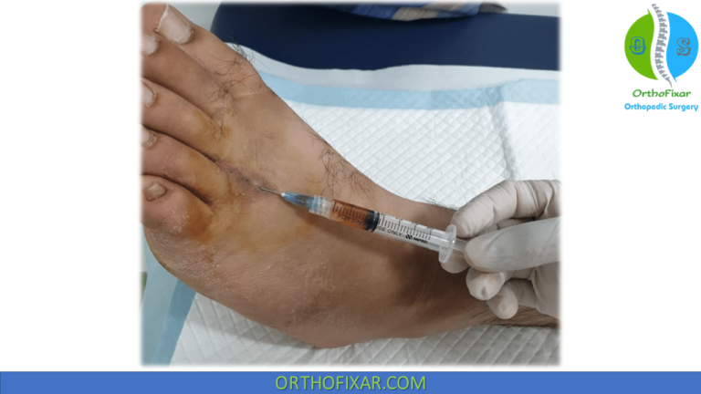 Morton's Neuroma Injection