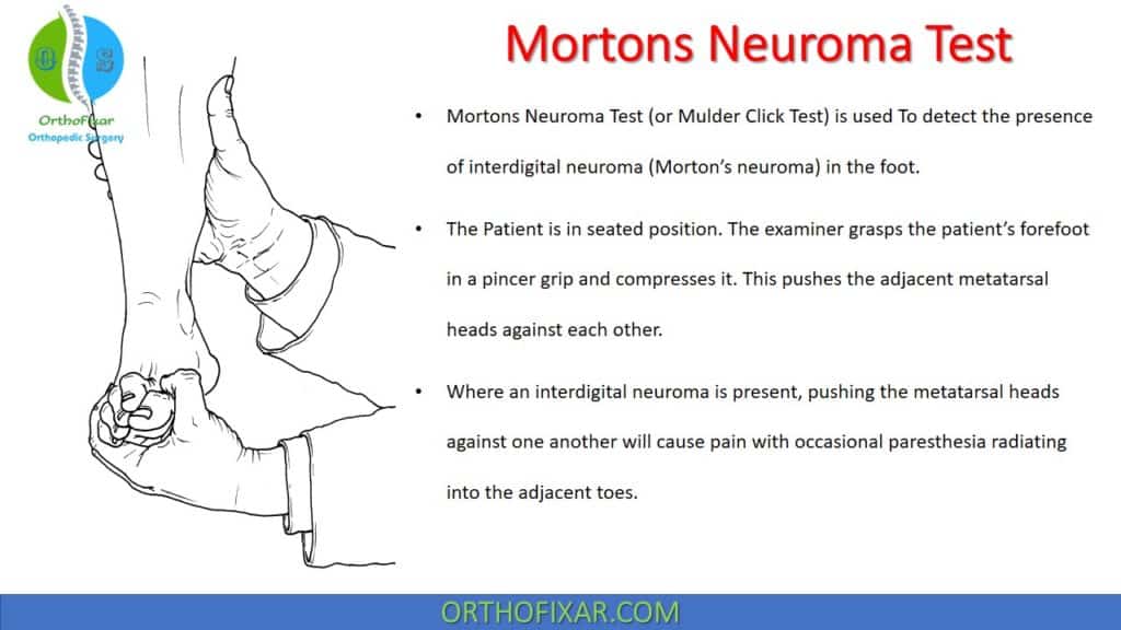 Mortons Neuroma Test Explained Easily | OrthoFixar
