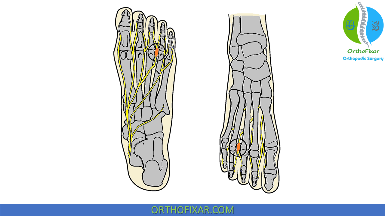 Morton's Neuroma Injection