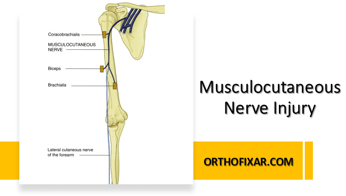 Musculocutaneous Nerve Injury | OrthoFixar