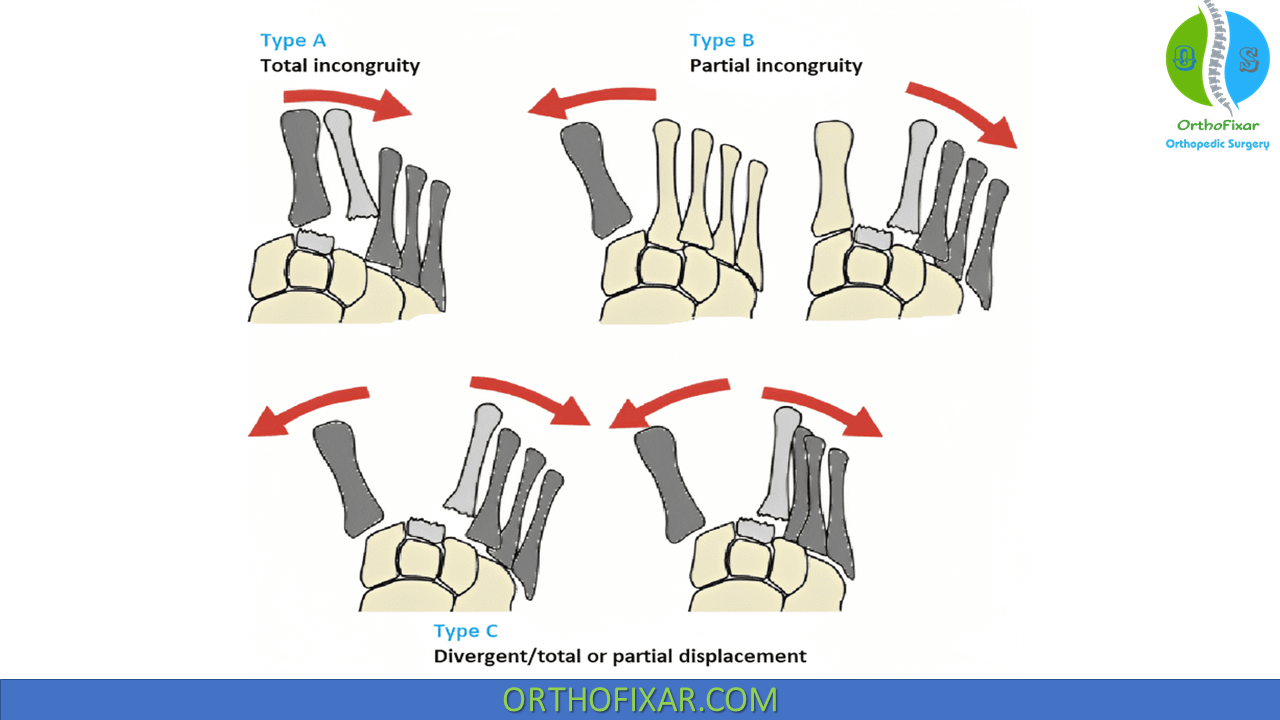 Lisfranc Fracture | OrthoFixar