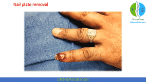 Nail Bed Repair