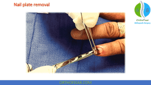 Nail Bed Repair