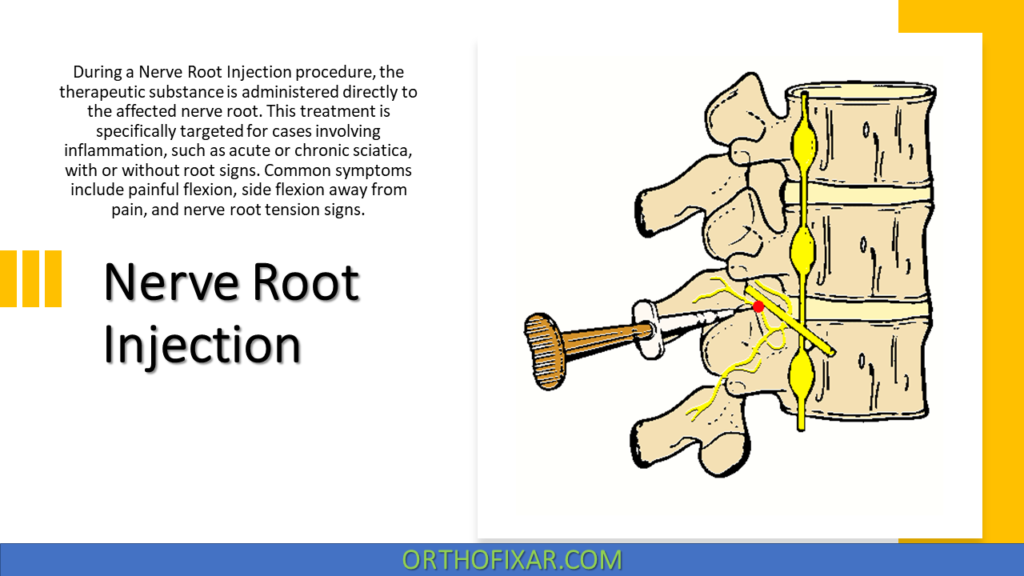 Nerve Root Injection - Full Review | OrthoFixar 2025