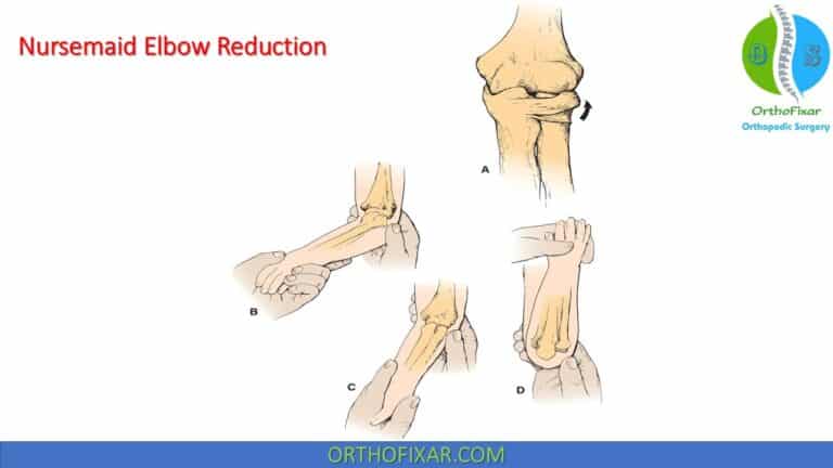 Nursemaid Elbow | OrthoFixar