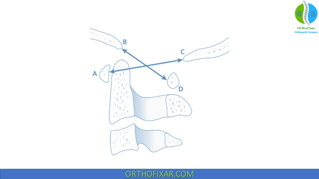 Occipitocervical Dissociation | OrthoFixar