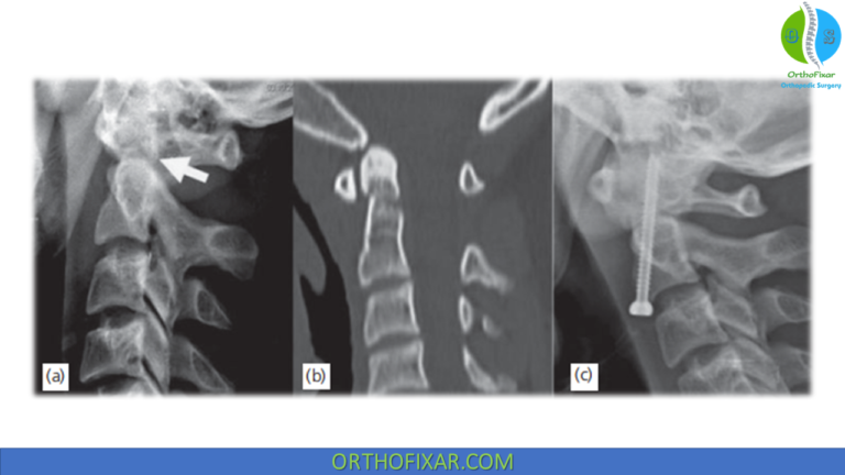 Odontoid Fracture | OrthoFixar