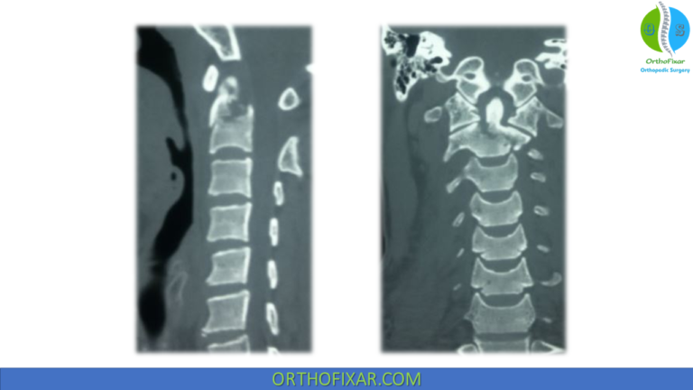 Odontoid Fracture | OrthoFixar
