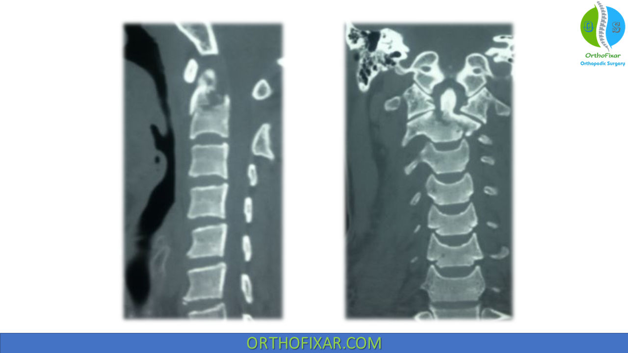 Odontoid Fracture | OrthoFixar