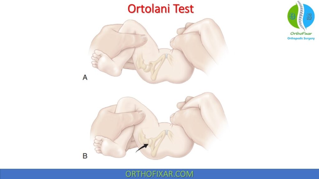 Ortolani Test Explained Easily | OrthoFixar