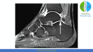 Os Trigonum Syndrome | OrthoFixar