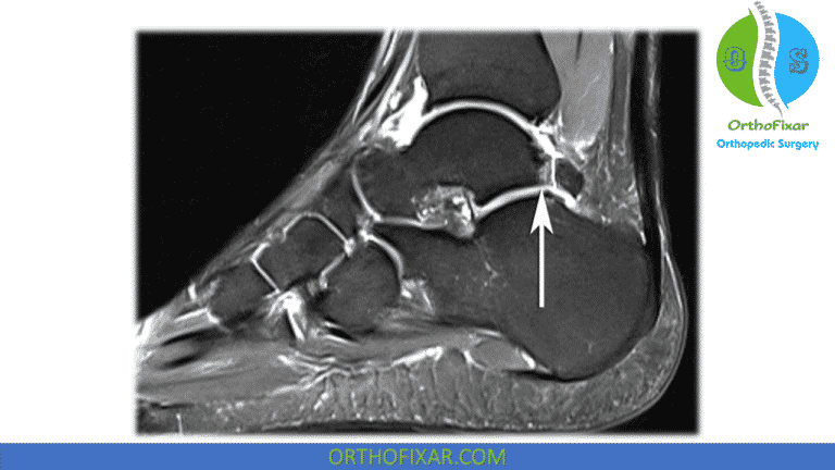 Os Trigonum Syndrome | OrthoFixar