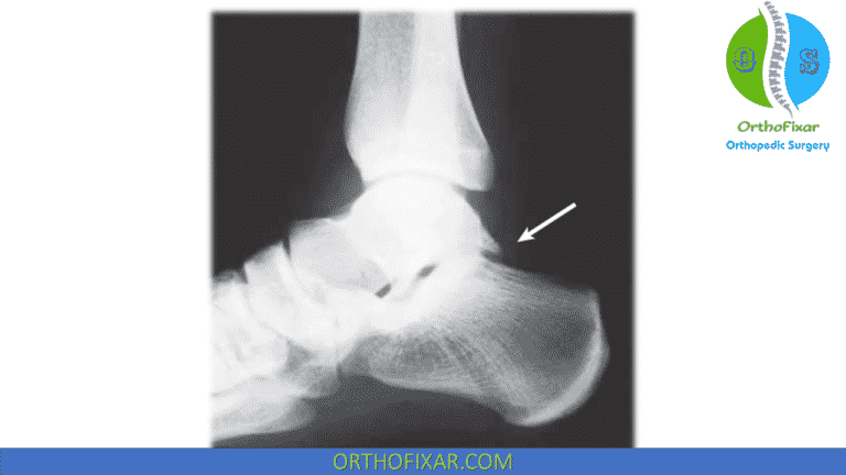 Os Trigonum Syndrome | OrthoFixar