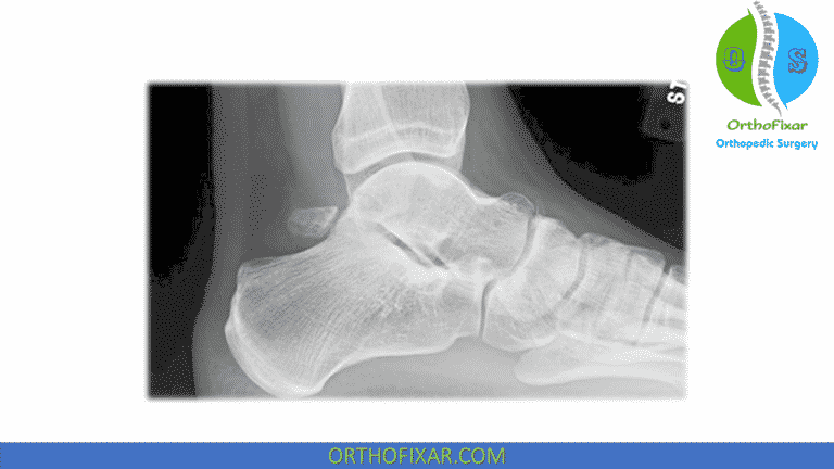 Os Trigonum Syndrome | OrthoFixar