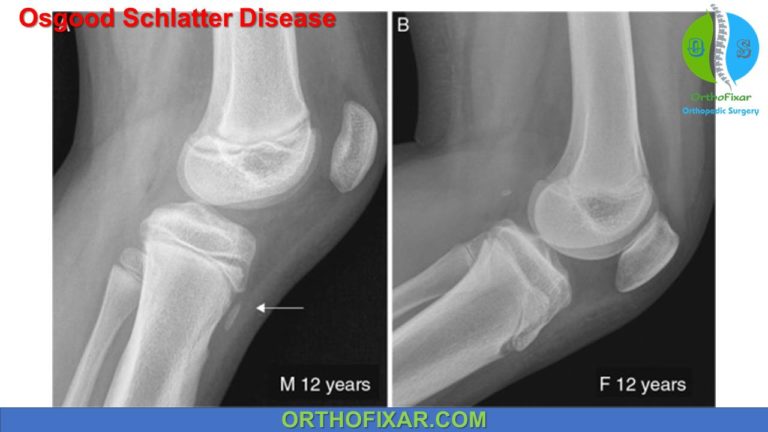 Osgood Schlatter Disease Full Detailed Orthofixar 2024