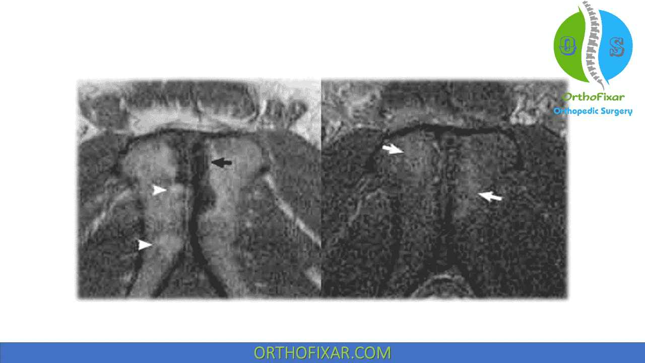 Osteitis Pubis | Orthopedic Learning