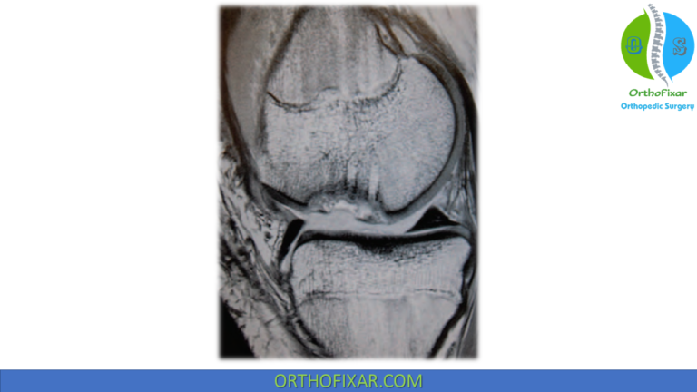 Osteochondral Allograft Transplantation Easily Step-By-Step | OrthoFixar