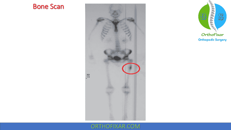 Osteoid Osteoma Overview