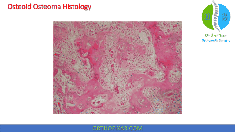 Osteoid Osteoma Overview