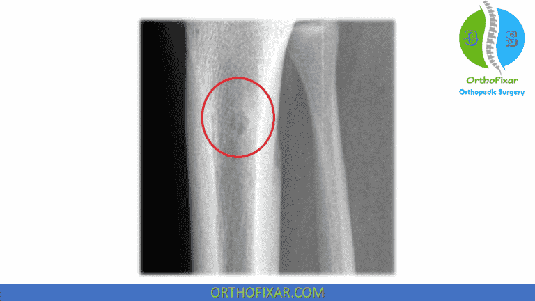 Osteoid Osteoma Overview | OrthoFixar