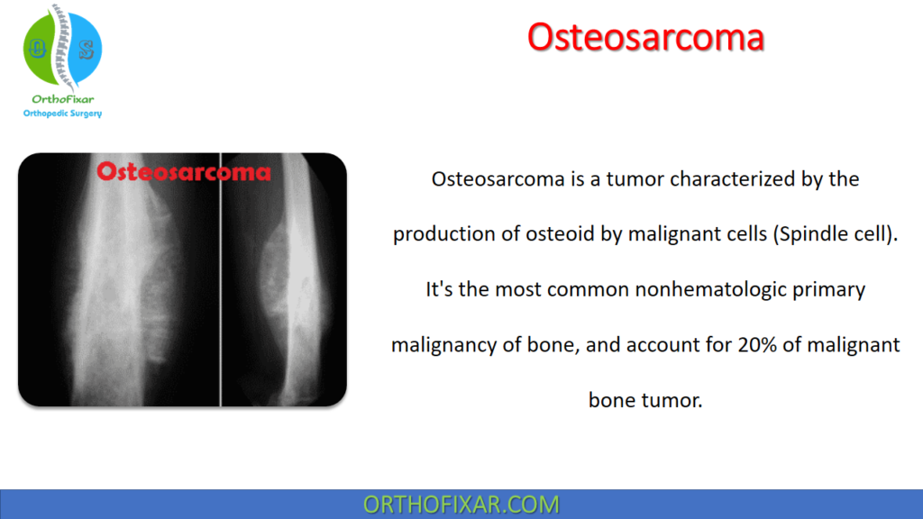 Osteosarcoma - Easy Explained | OrthoFixar 2026