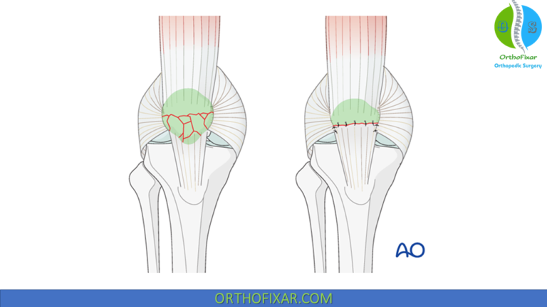 Patellar Fractures | Broken Kneecap | Orthopedic Learning
