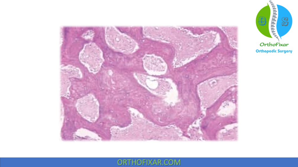 Osteosarcoma Histology Labeled