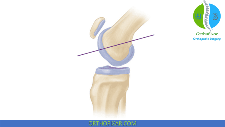 Patellar Instability - Easy Explained | OrthoFixar 2026