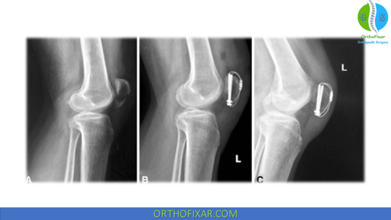 Patellar Fractures | Broken Kneecap | OrthoFixar